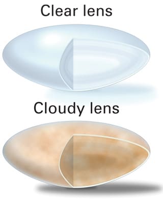 Lens Implants for Cataract surgery: You have choices! - Jahnle Eye ...